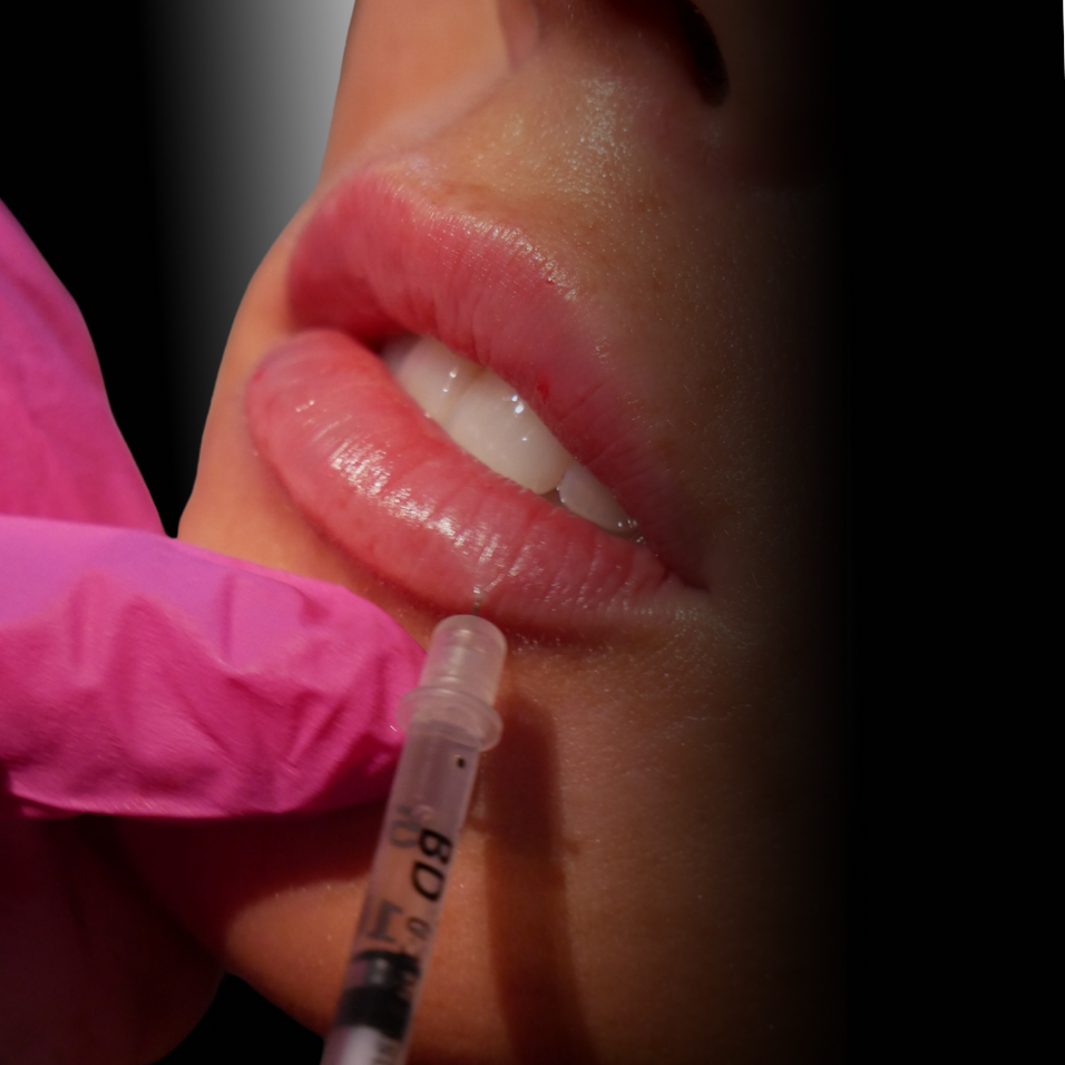 RE•INJECT | Injections esthétiques à Terrebonne | Murphy Clinique ...